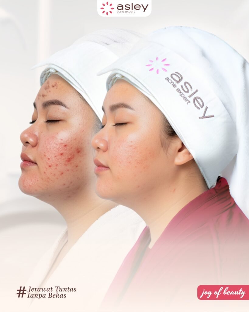 Cara Menghilangkan Bekas Jerawat Secara Alami dan Medis